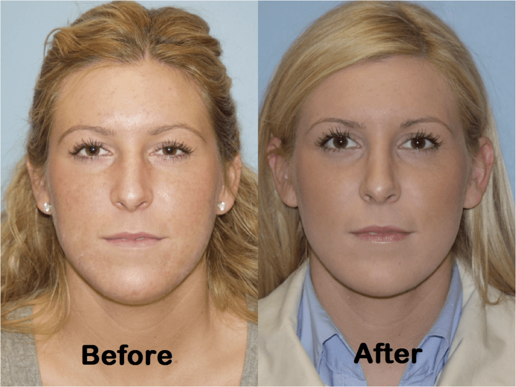 Hairline Lowering Without Surgery Turkey | Expert Hair Transplant